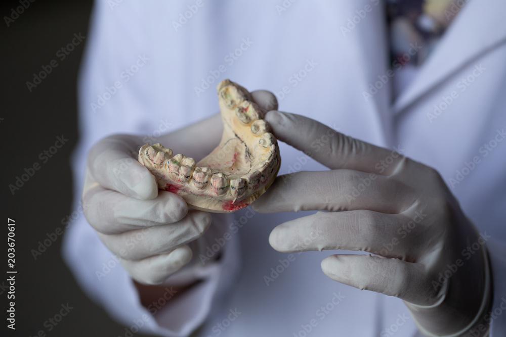 Study cast of Diagnostic cast and dental gypsum models in dental ...