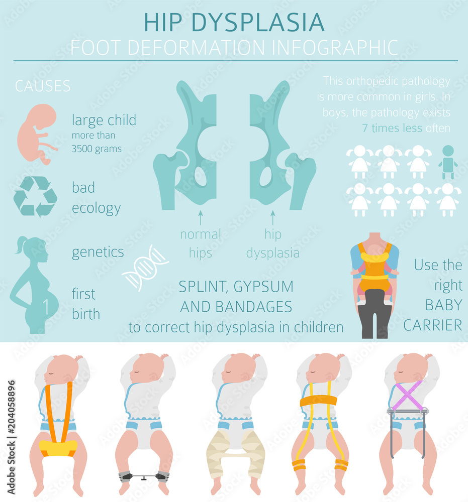 Foot deformation types, medical desease infographic. Hip dysplasia in ...