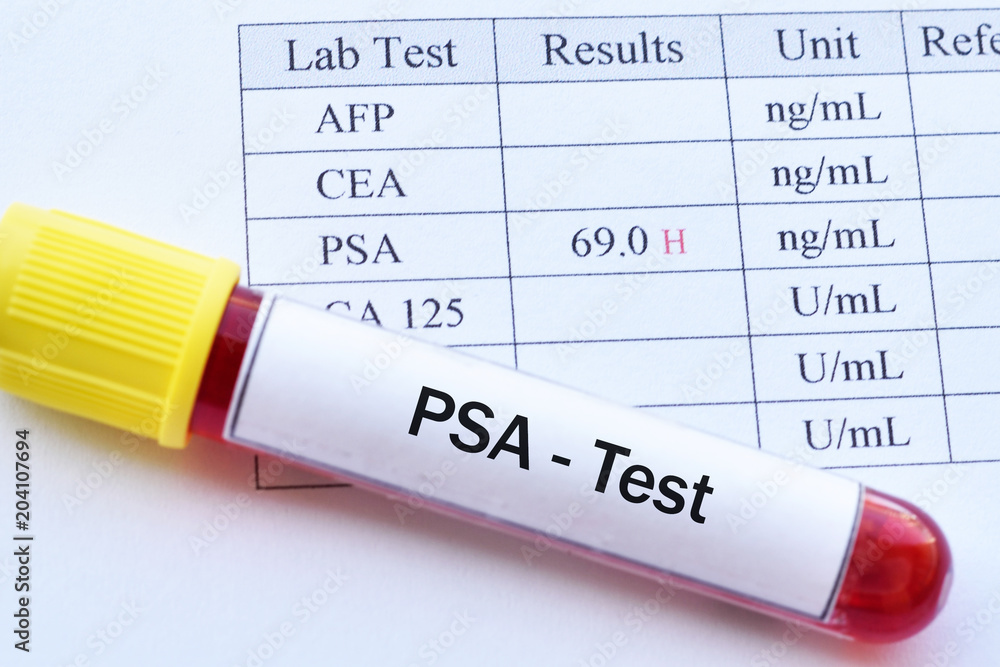 Blood sample with abnormal high PSA test result Stock Photo | Adobe Stock