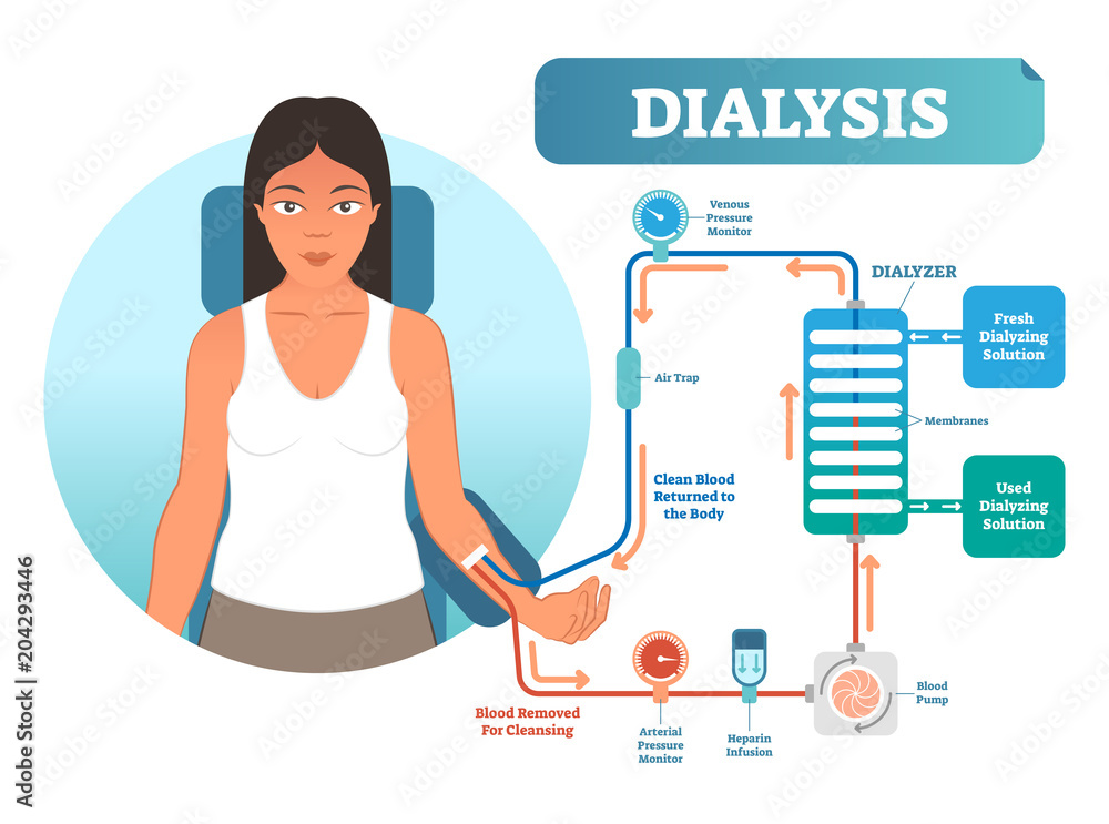 Dialysis medical procedure system vector illustration diagram ...