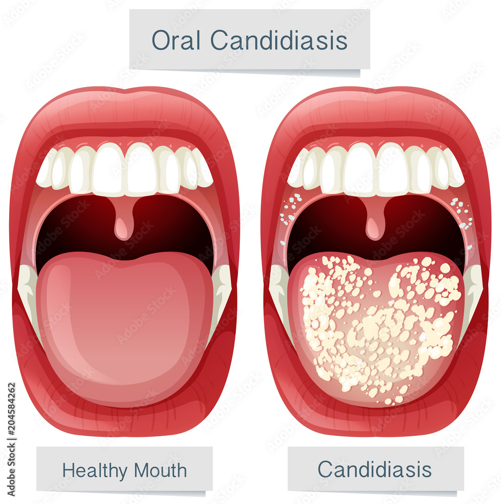 Human Mouth Anatomy Oral Candidiasis Stock Vector | Adobe Stock