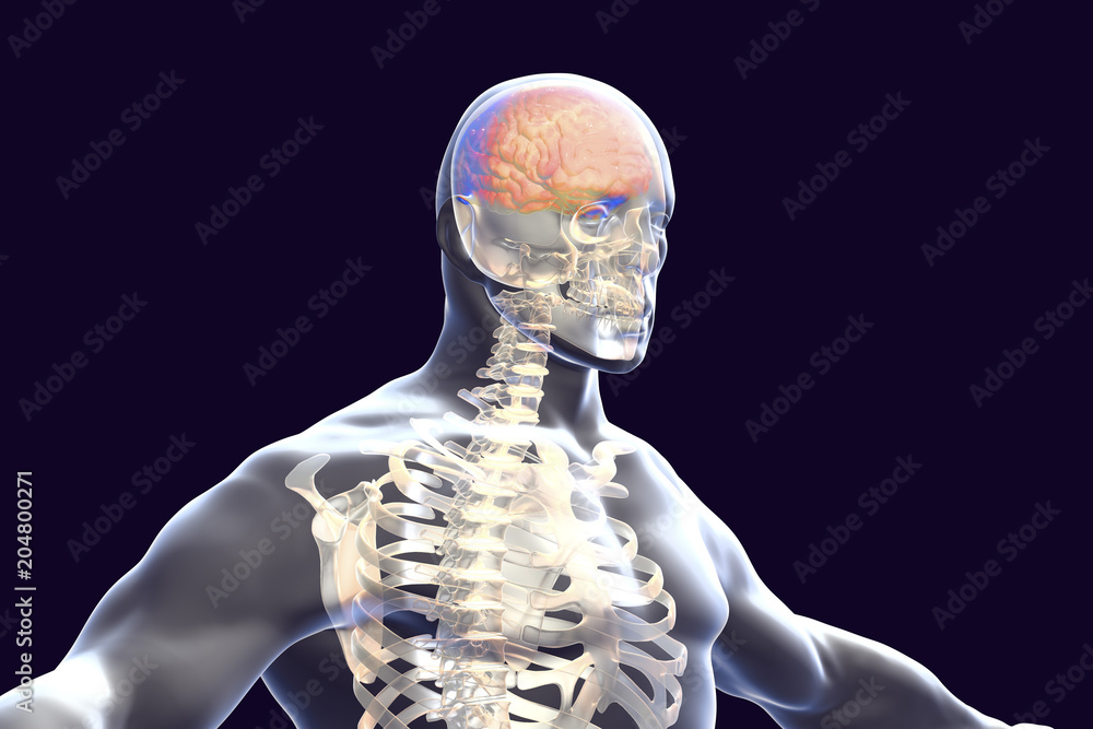 Encephalitis concept, 3D illustration showing edema and hemorrhages in ...