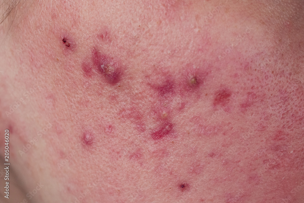 acne on the skin close up Stock Photo | Adobe Stock
