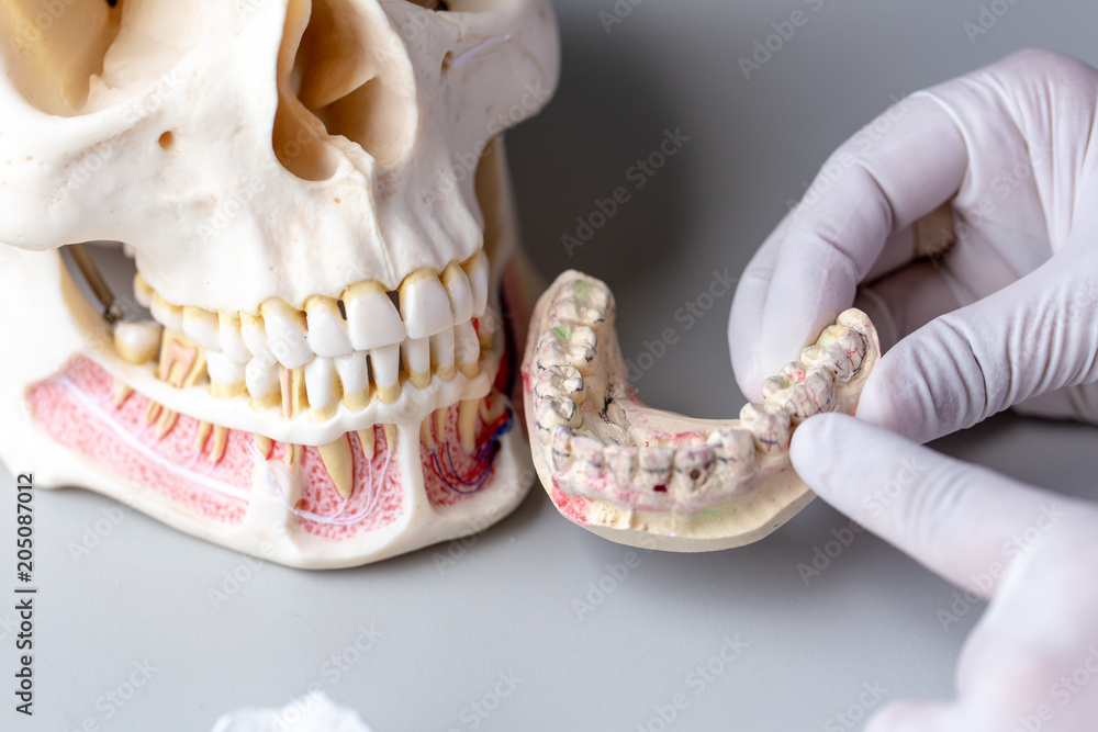 Study cast of Diagnostic cast and dental gypsum models in dental ...