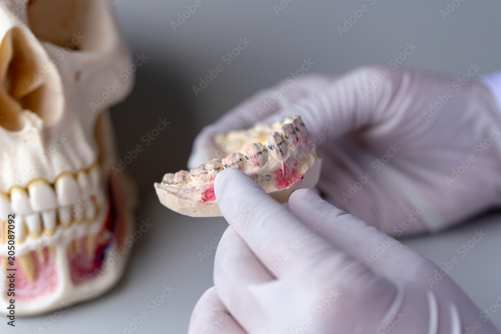 Study cast of Diagnostic cast and dental gypsum models in dental ...