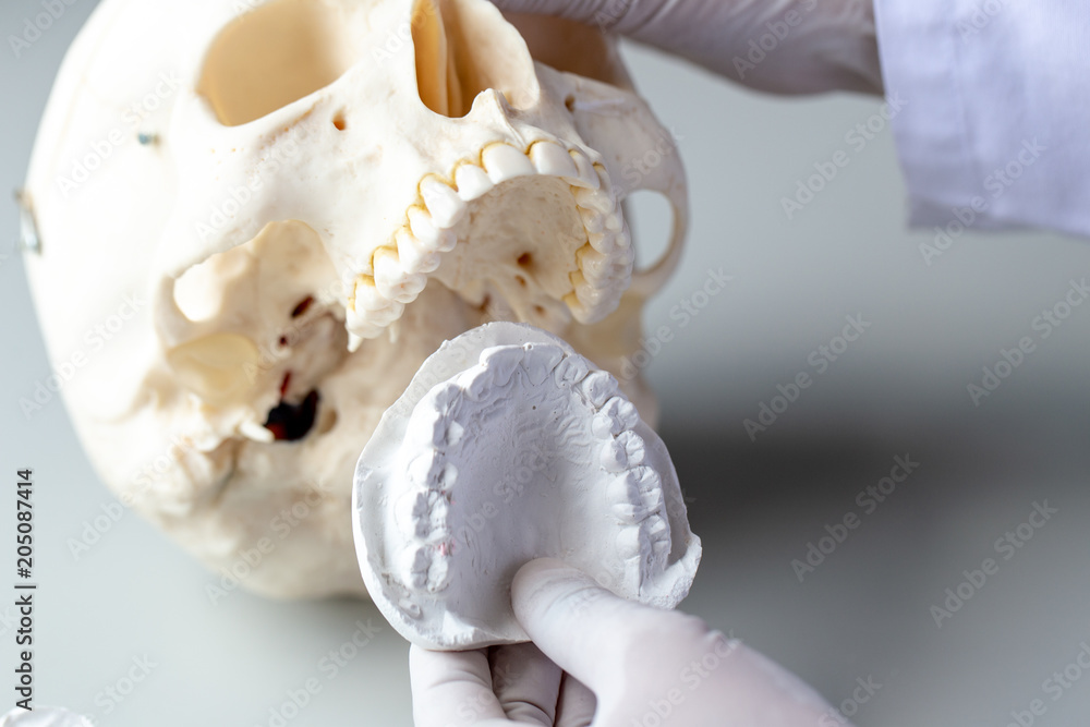 Study cast of Diagnostic cast and dental gypsum models in dental ...