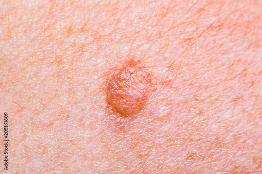 Skin Mole Defect High Magnification Macro Photo for Medical Diagnosis ...