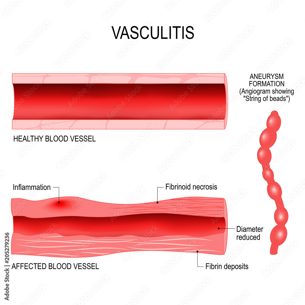 Vasculitis is damange of blood vessels by inflammation. Stock Vector ...