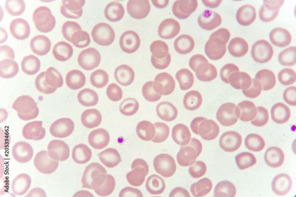 Target cells with abnormal red blood cells from anemia patient, analyze ...