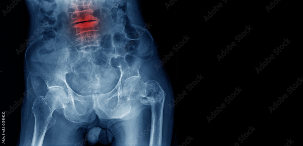 compression fracture lumbar L4-5, S1 level with loss space of disc ...