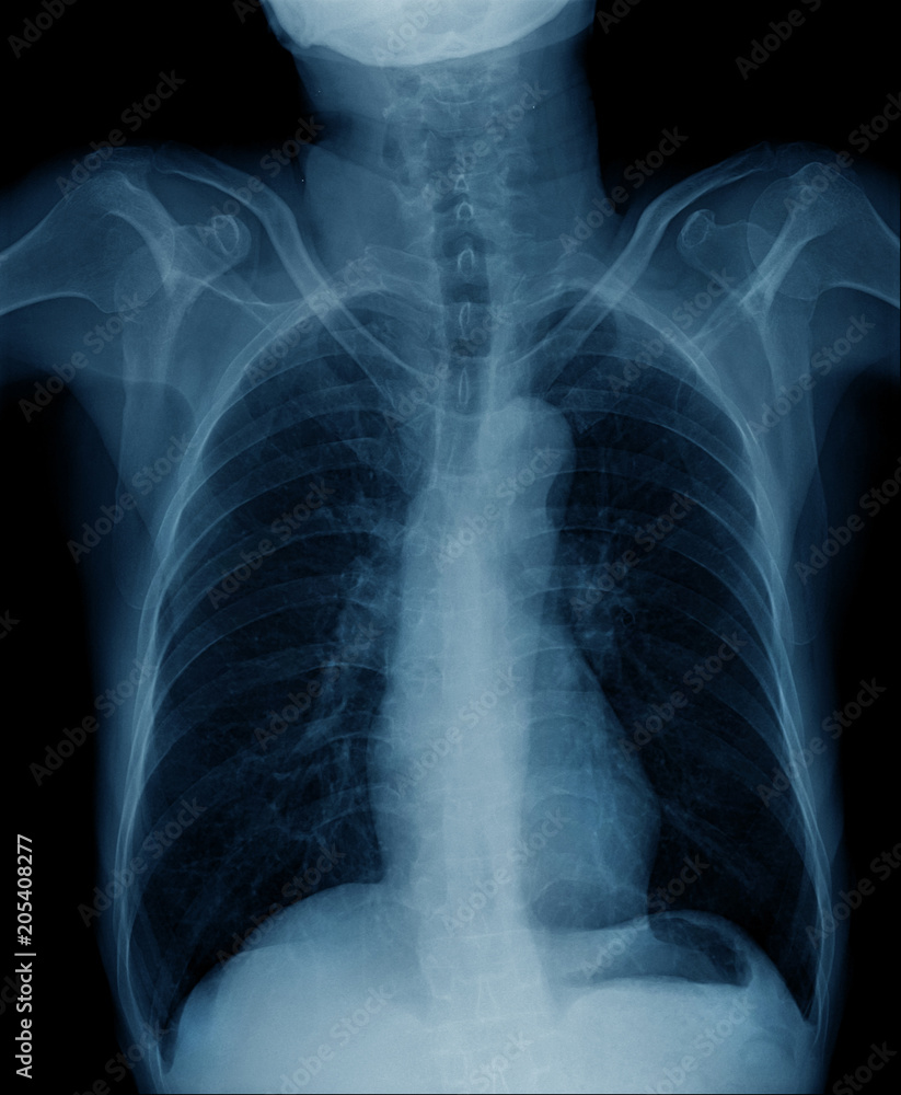 chest x-ray image, high quality of chest xray show secretion of both ...
