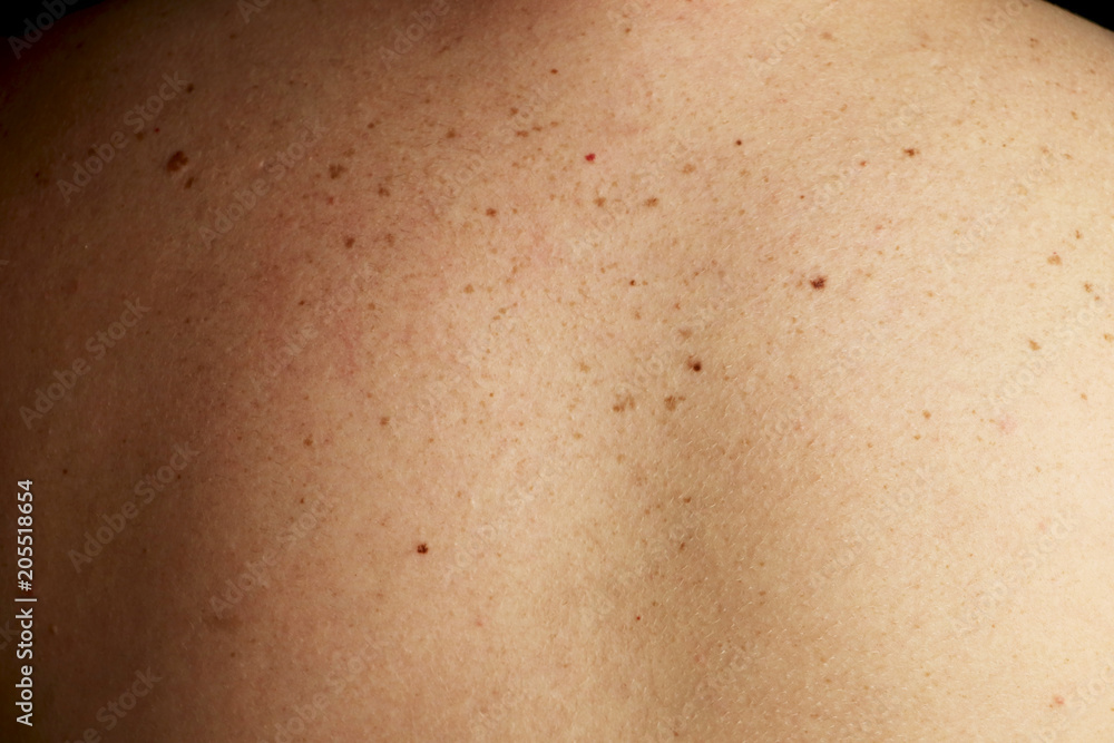 Close up detail of the bare skin on a man back with scattered moles and ...
