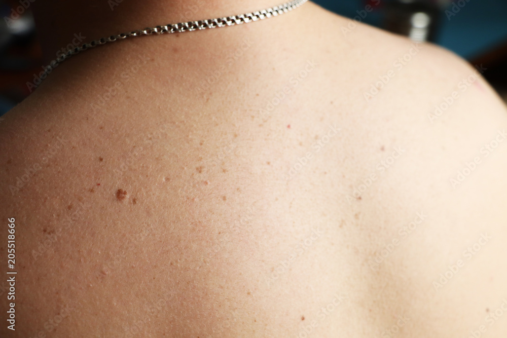 Close up detail of the bare skin on a man back with scattered moles and ...
