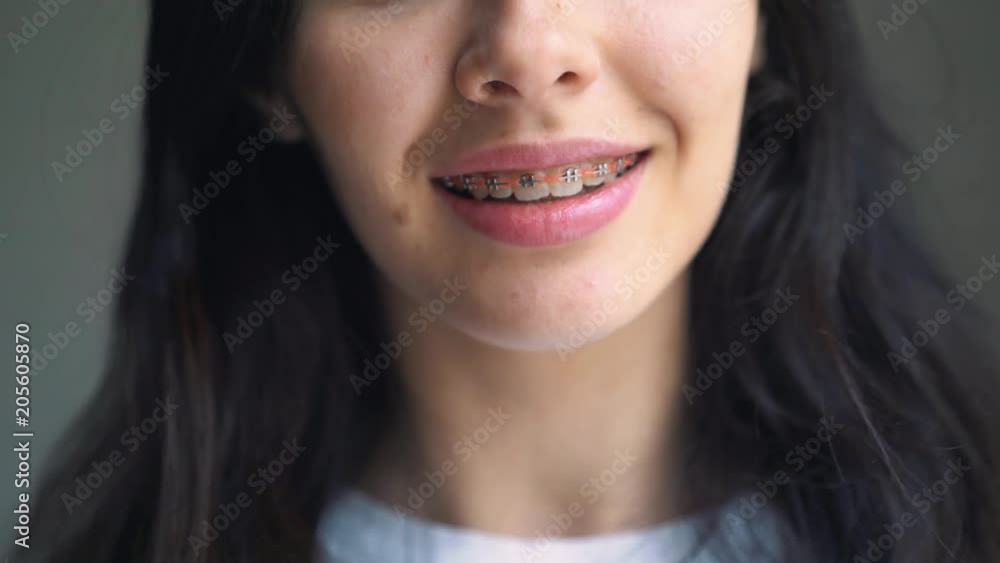 Vidéo Stock A young girl with braces on her teeth tilts her head and ...