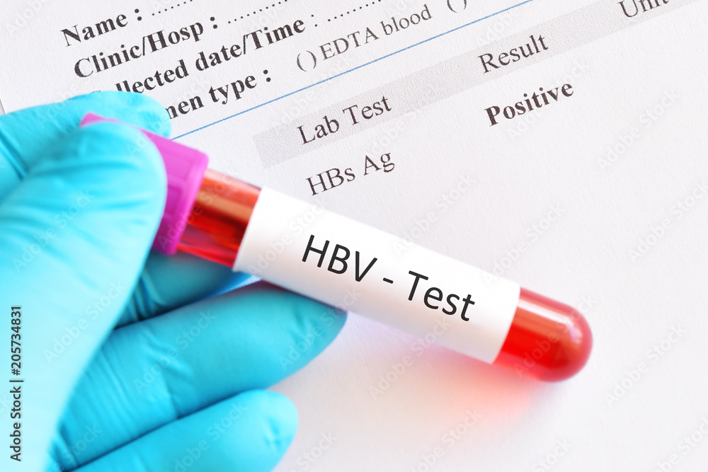 Hepatitis B virus positive test result with blood sample tube Stock ...