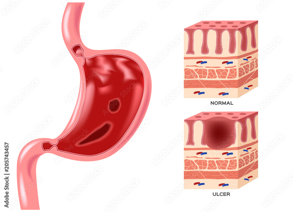 stomach peptic ulcer helicobacter pylori vector / Celiac disease Small ...