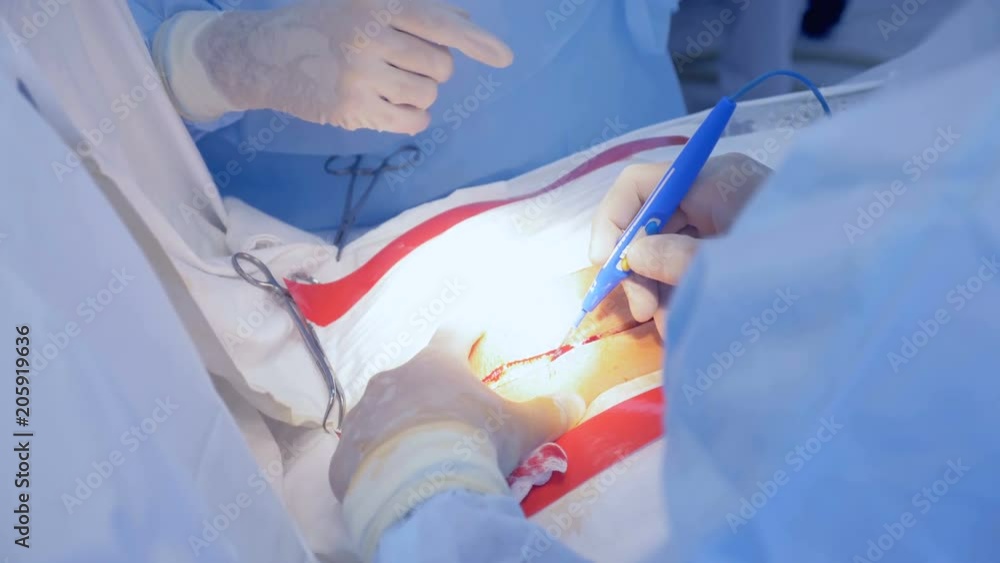 Skin incision with an electric scalpel. Stock ビデオ | Adobe Stock