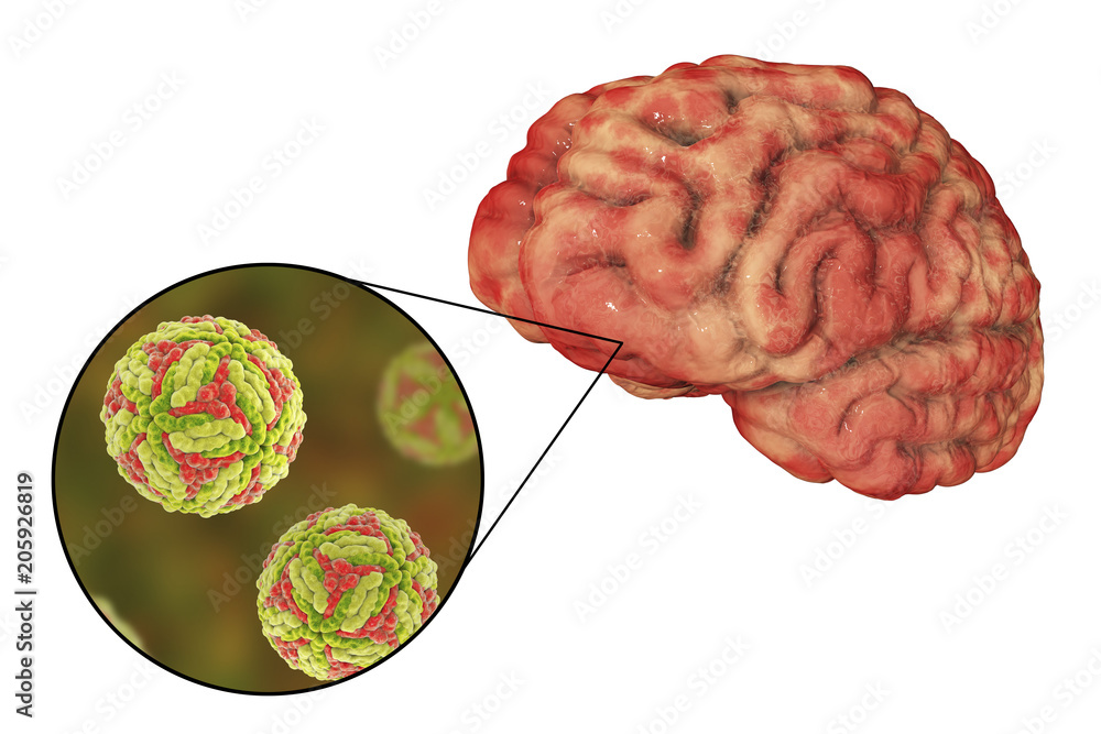 Japanese encephalitis, medical concept, 3D illustration showing brain ...