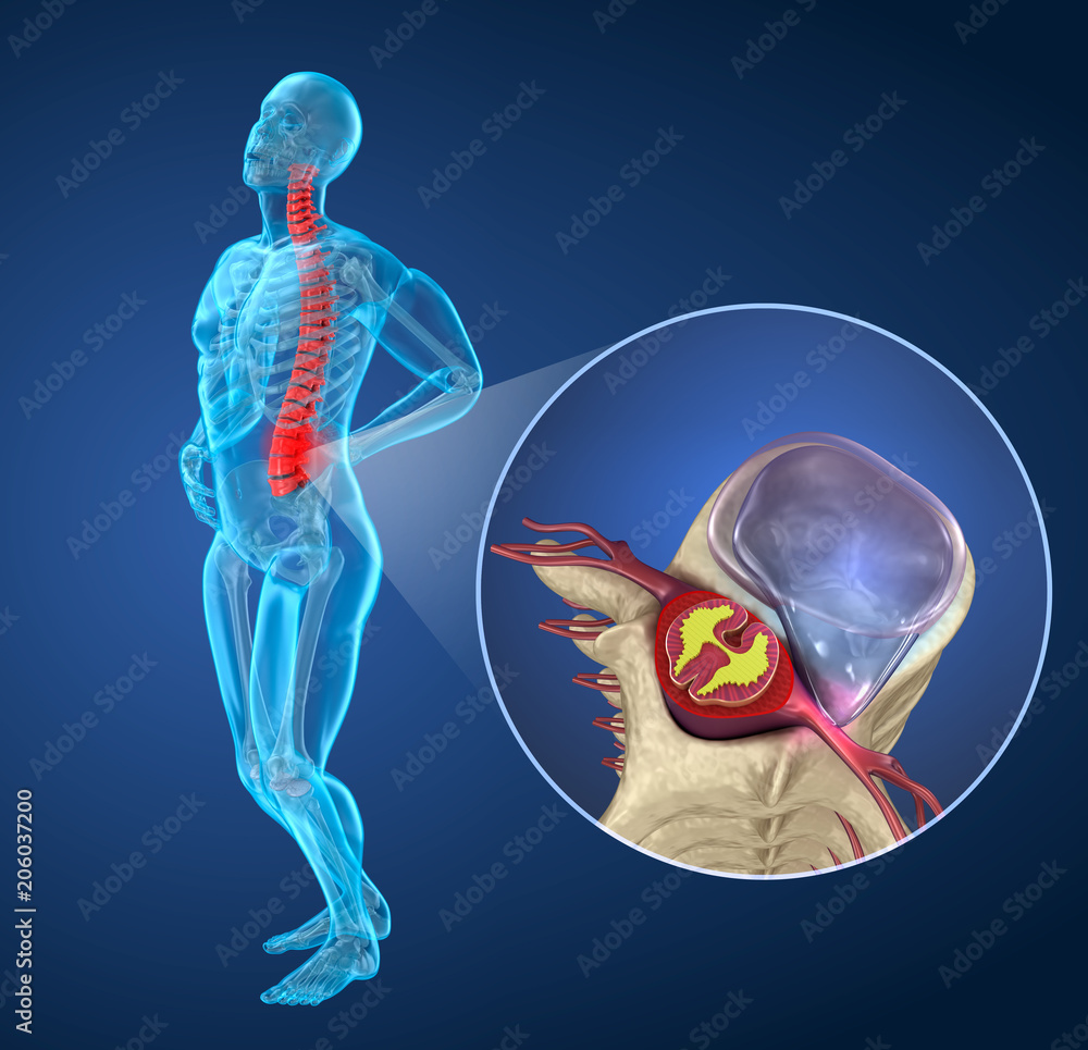 Spinal pain Attack after disc herniation, man suffering from spinal ...