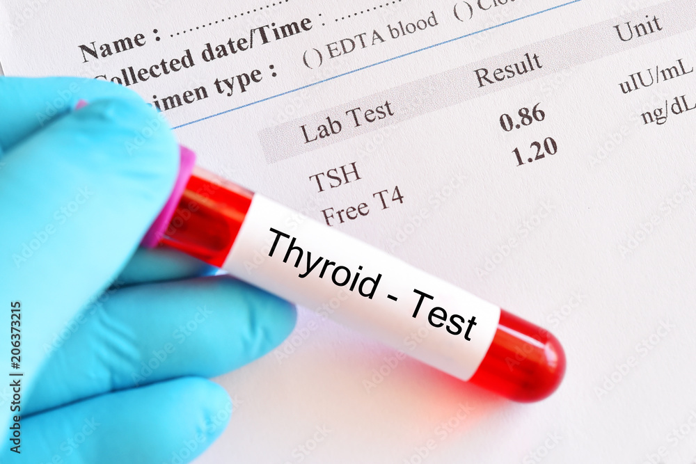 Blood sample tube with normal thyroid hormone test result Stock Photo ...
