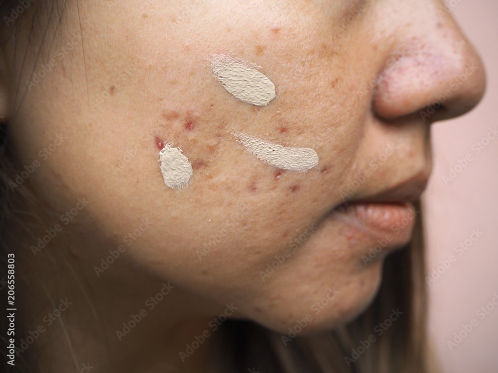 woman face with skin problems, melasma, acne scar, skin problems ...