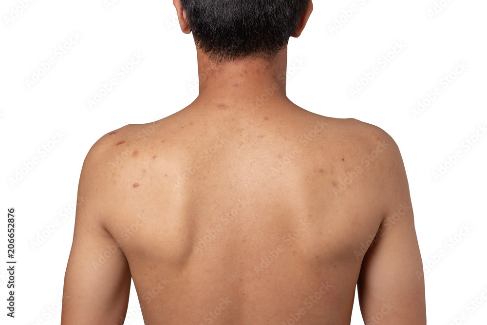 Man with acne,scar spots on the back isolated on white background Stock ...