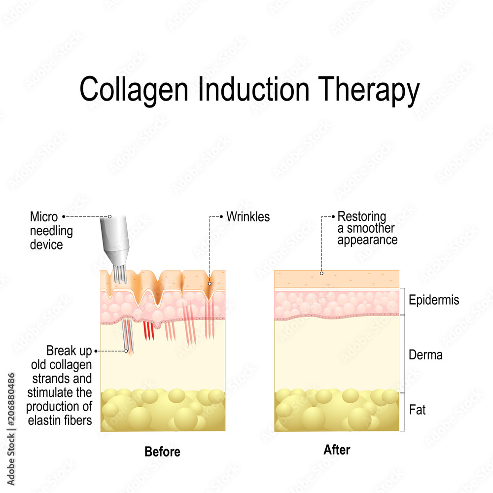 Collagen induction therapy (microneedling) Stock Vector | Adobe Stock Collagen induction therapy (microneedling) Stock Vector | Adobe Stock