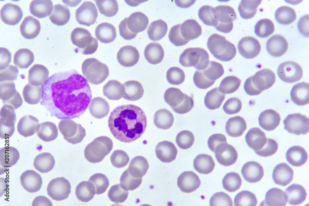 Monocyte and neutrophil cell in blood smear, analyze by microscope ...