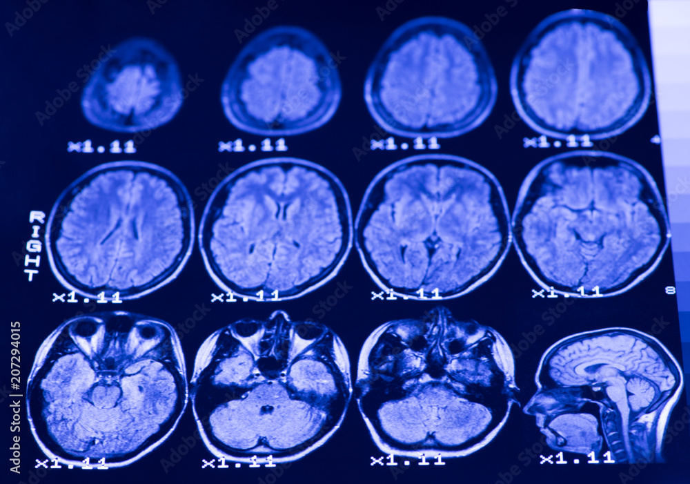 The result of MRI of the brain of a healthy person with blue backlight ...