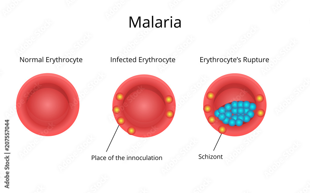 Malaria infection.Normal erythrocyte with the infected blood cell Stock ...