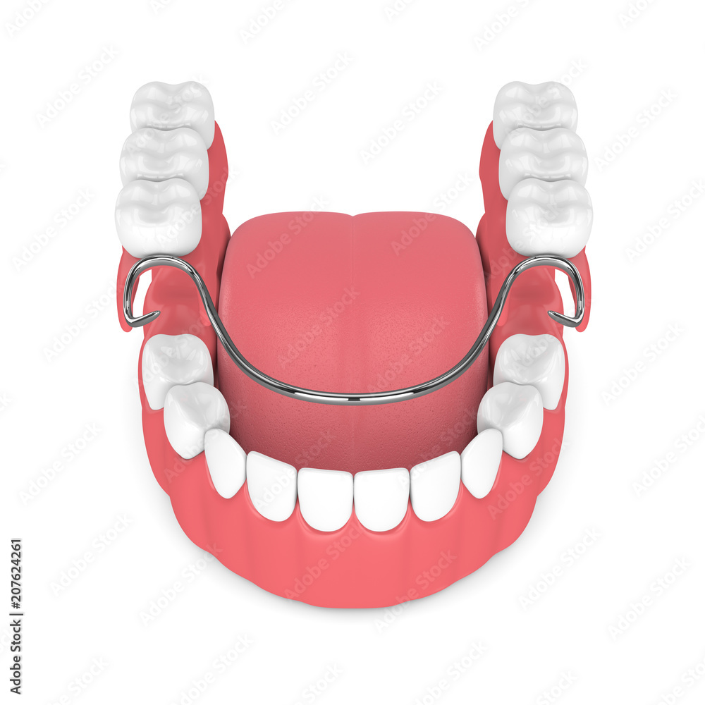 3d render of removable partial denture Stock Illustration | Adobe Stock