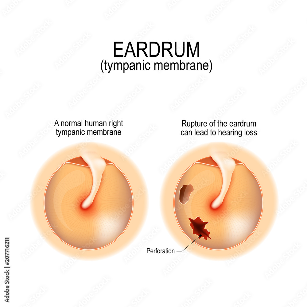 Ruptured (perforated) eardrum Stock Vector | Adobe Stock