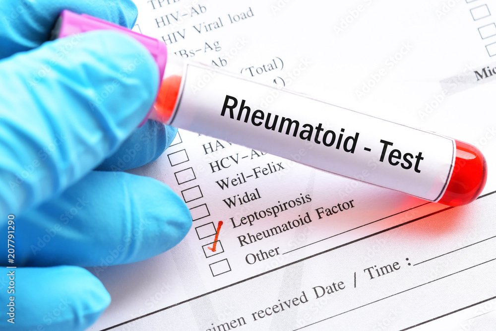 Blood sample with laboratory requisition form for rheumatoid factor (RF ...