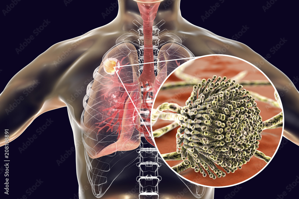 Aspergilloma of the lung and close-up view Aspergillus fungi, 3D illustration. Also known as ...