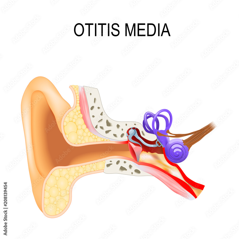 Otitis media. Human anatomy. Stock Vector | Adobe Stock