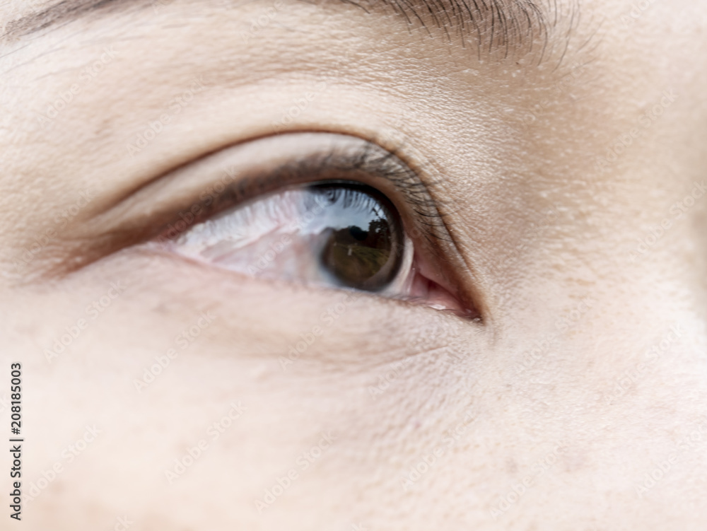 the women have a Pinguecula in her eye Stock Photo | Adobe Stock