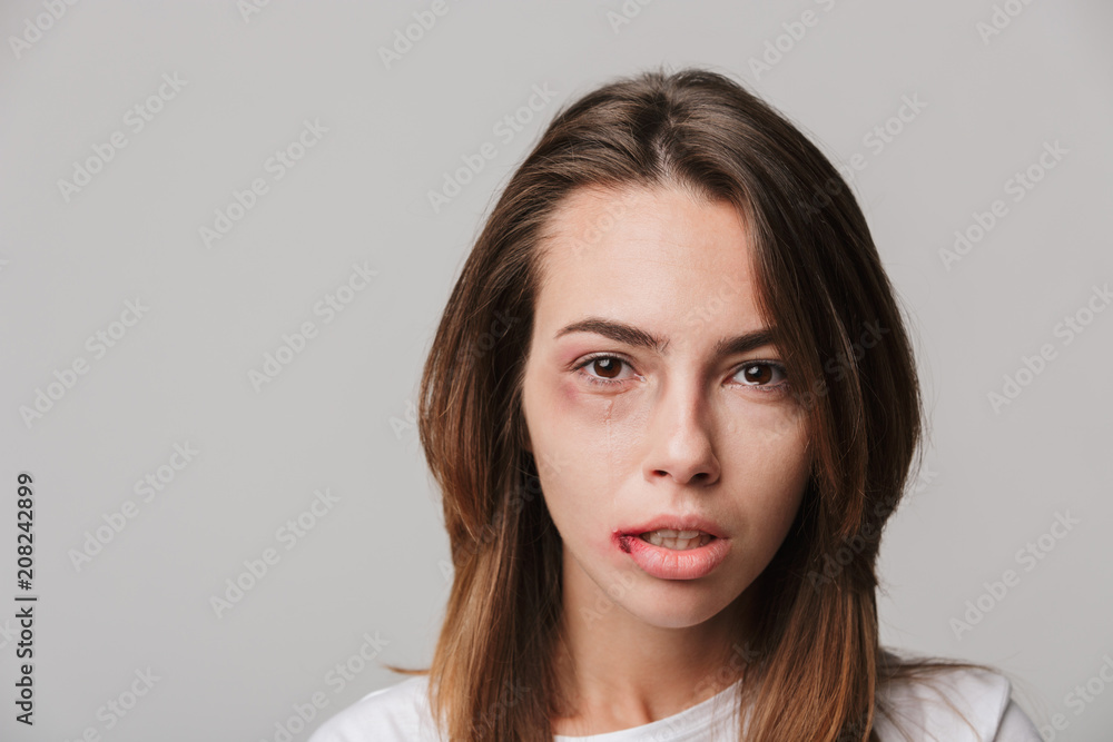 Disabled young girl with scratches and bruises on her face Stock Photo ...