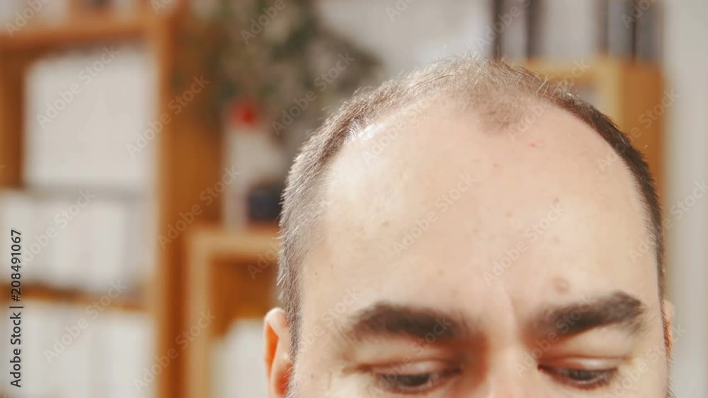 Man with hair loss problems close-up 4K. Long shot dolly slide of mand ...