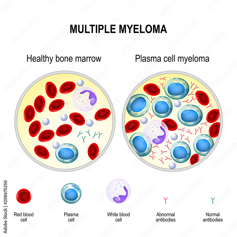 Multiple myeloma. plasma cell myeloma Stock Vector | Adobe Stock