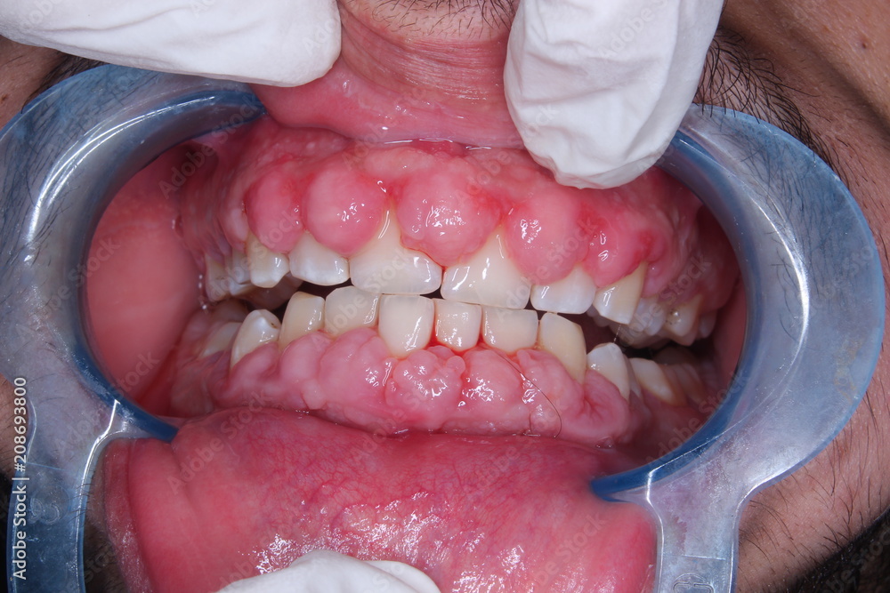 drug induced gingival enlargement Stock Photo | Adobe Stock