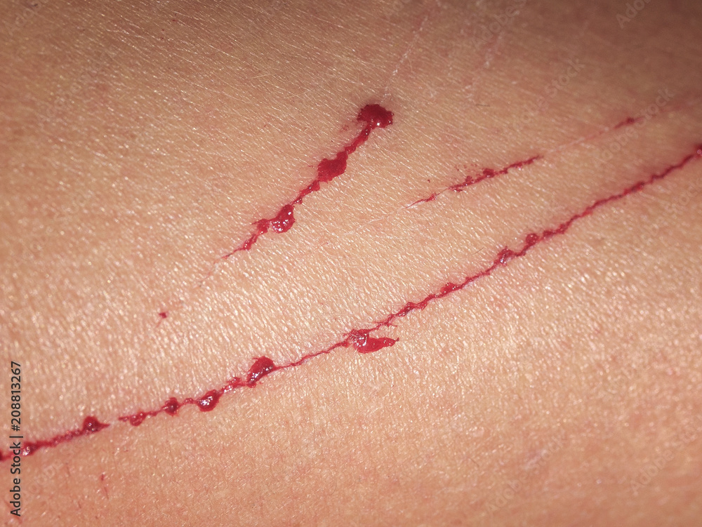 pain and itching from the wound and scratches with drops of blood on ...