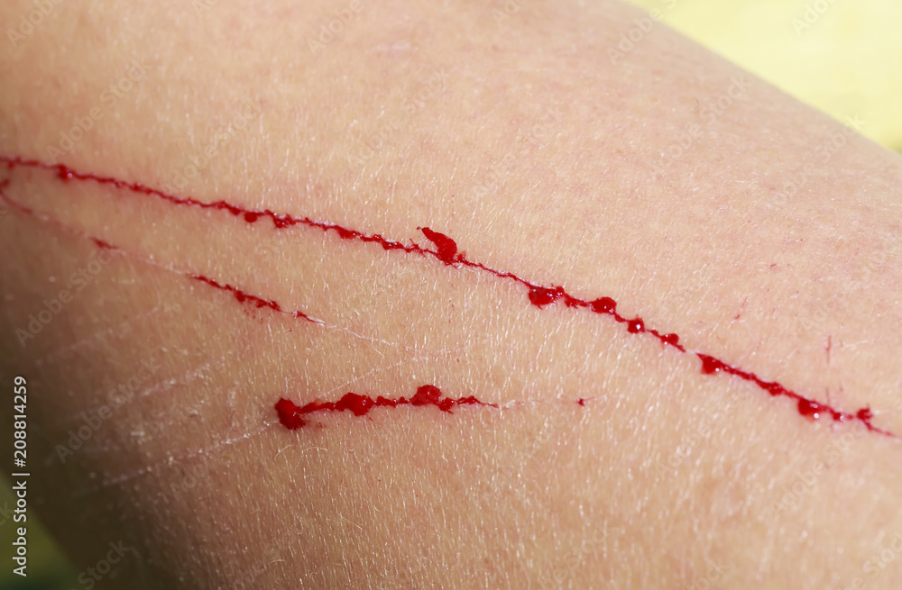 pain and itching from the wound and scratches with drops of blood on ...