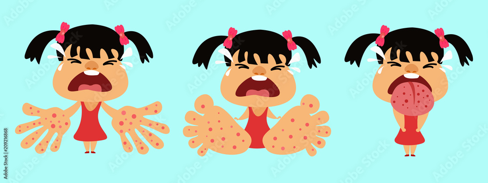 Vetor de HFMD children infected. hand foot and mouth disease. Girl ...