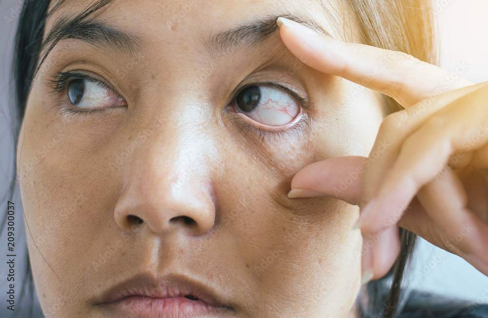 Eyelid layer,Veins on red eye asian woman,Causes the use of eyes and ...