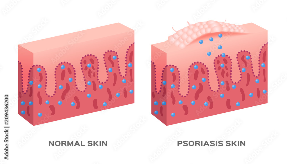skin disease vector / psoriasis Stock Vector | Adobe Stock