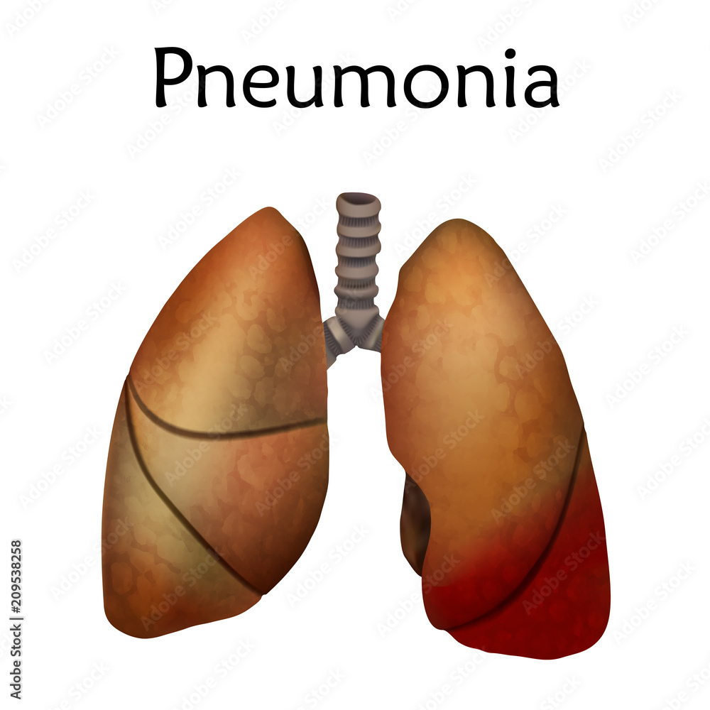 Human lungs. Pneumonia. Anatomy vector illustration. White background ...