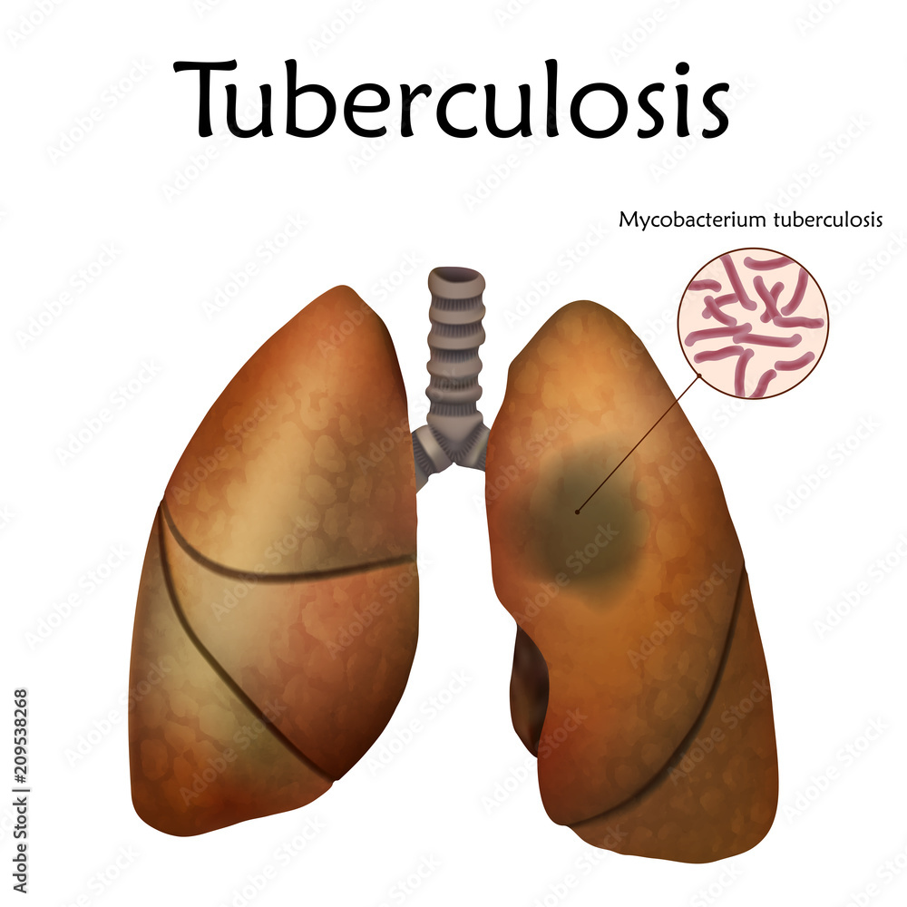 Human lungs. Tuberculosis. Anatomy vector illustration. White ...