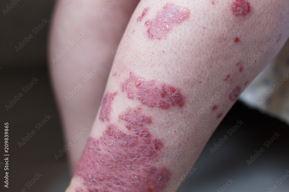 Allergic rash dermatitis eczema skin on leg of patient. Psoriasis and ...