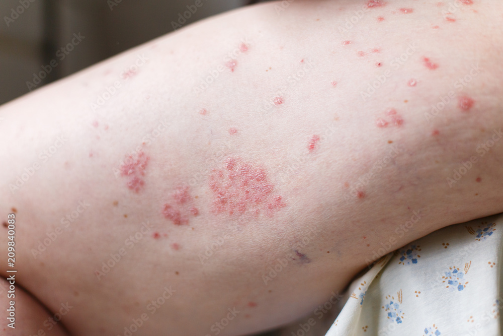 Allergic rash dermatitis eczema skin on leg of patient. Psoriasis and ...