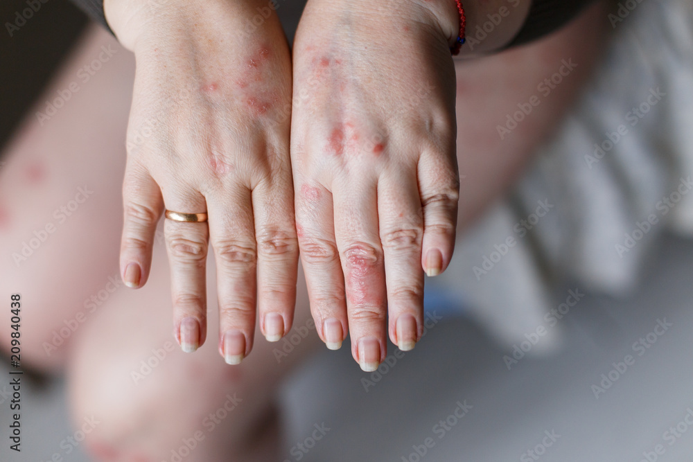 Wasp Sting On Finger